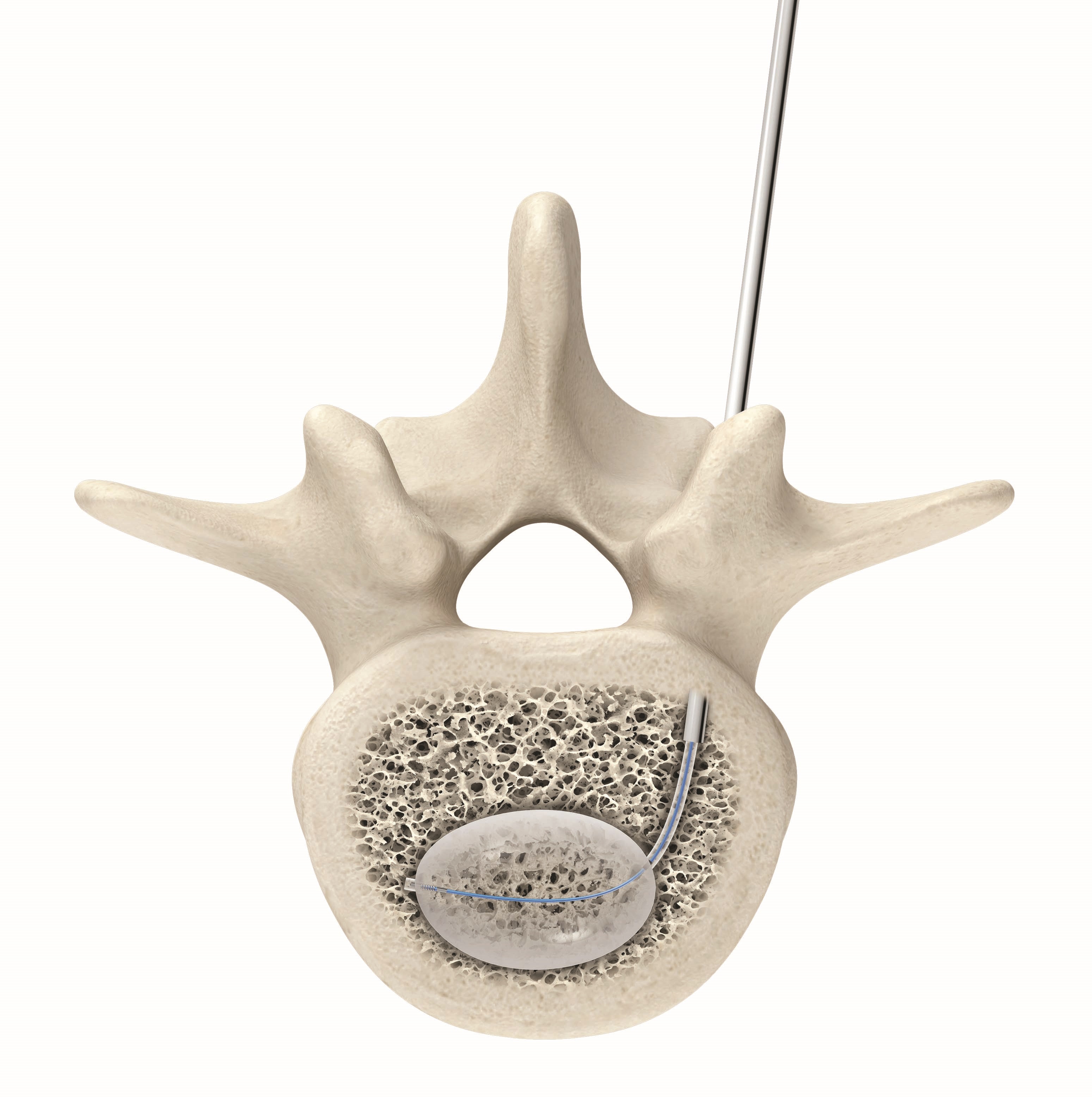 Stryker plays part in vertebral compression fracture treatment with ...